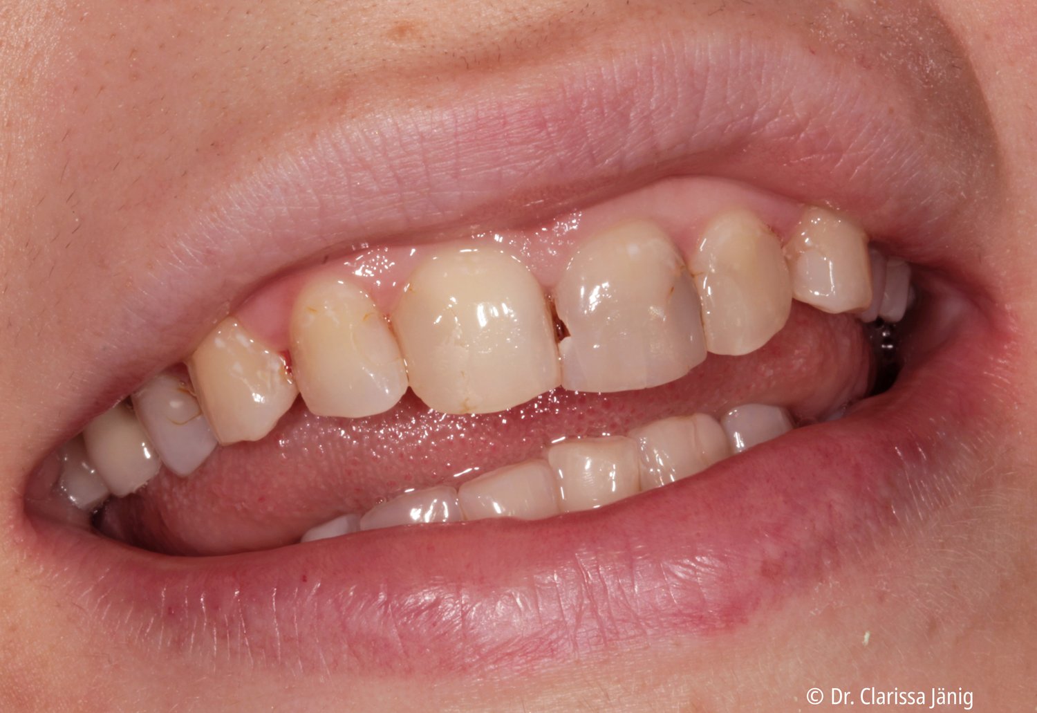 Cómo el blanqueamiento dental médico y cosmético puede cambiar la vida ...