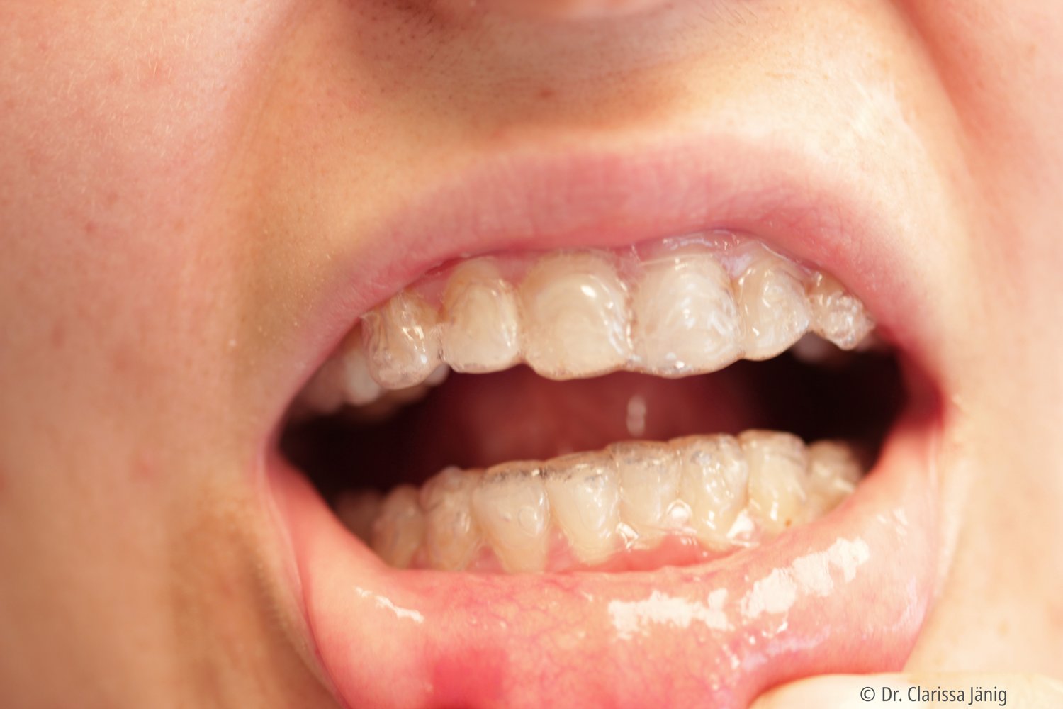 How Medical and Cosmetic Tooth Whitening can be Life-Changing: Using ...