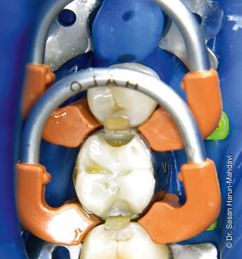 "Very well thought-out": Review of new sectional matrix system