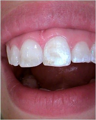 The minimally invasive enamel micro-abrasion technique: Spotless teeth ...