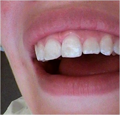 The minimally invasive enamel micro-abrasion technique: Spotless teeth ...