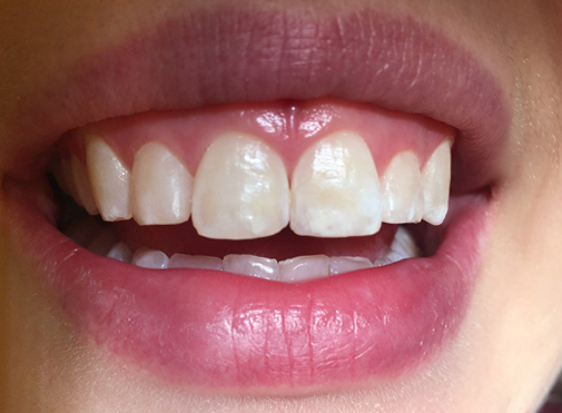 The minimally invasive enamel micro-abrasion technique: Spotless teeth ...