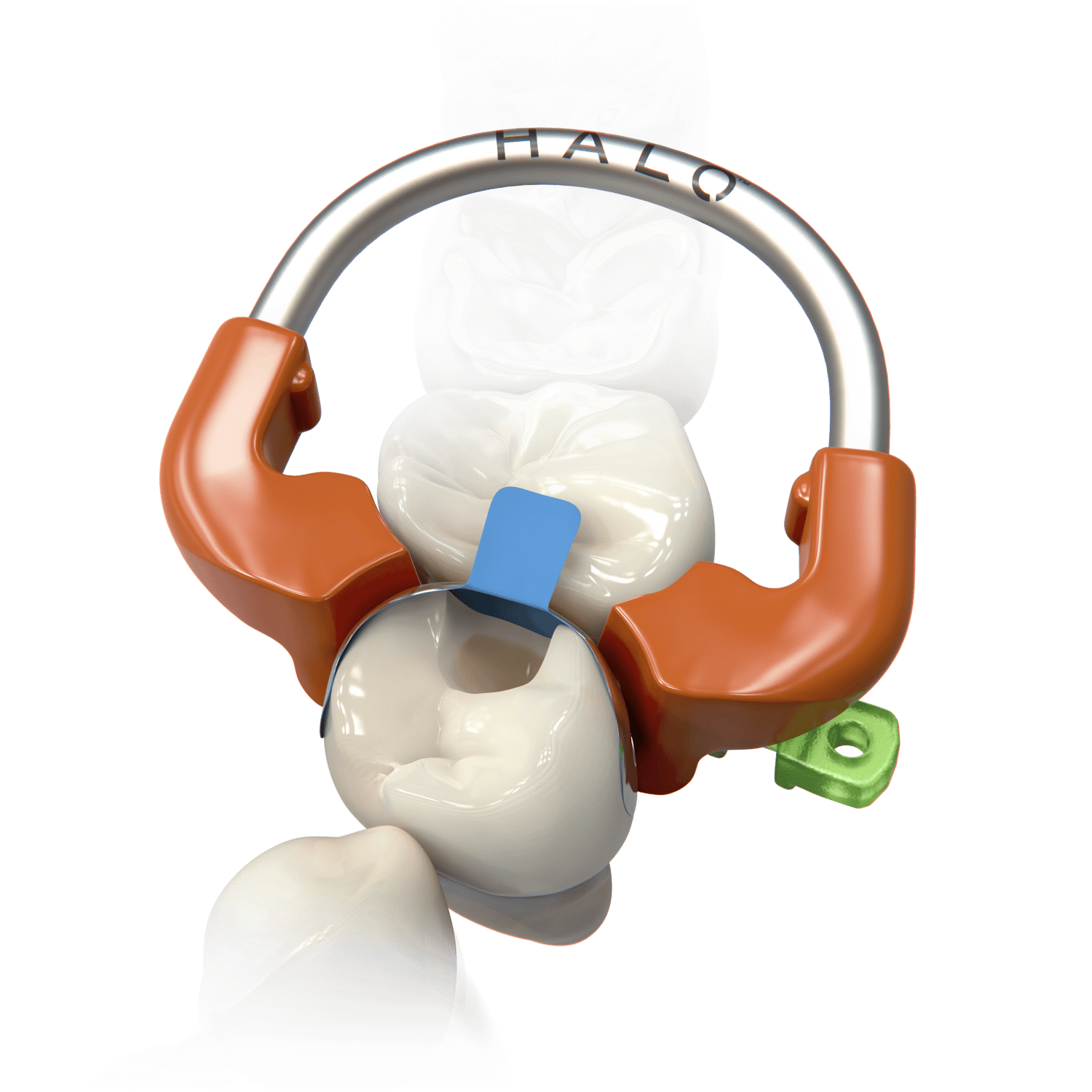 The Halo™ Sectional Matrix System: Beautiful Results in Less Time