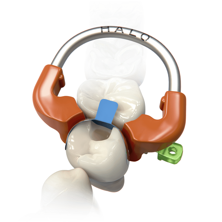 The Halo™ Sectional Matrix System: Beautiful Results in Less Time