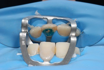 The walking bleach method: Efficient, uncomplicated and minimally ...