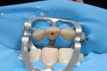 The walking bleach method: Efficient, uncomplicated and minimally ...