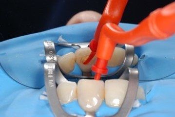 The walking bleach method: Efficient, uncomplicated and minimally ...