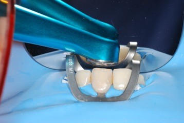 The walking bleach method: Efficient, uncomplicated and minimally ...