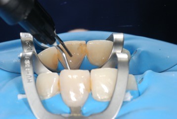 The walking bleach method: Efficient, uncomplicated and minimally ...