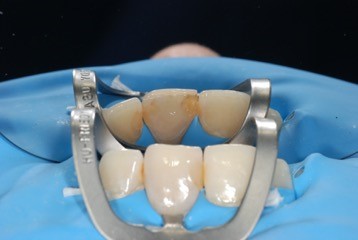 The walking bleach method: Efficient, uncomplicated and minimally ...