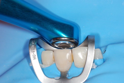 The walking bleach method: Efficient, uncomplicated and minimally ...