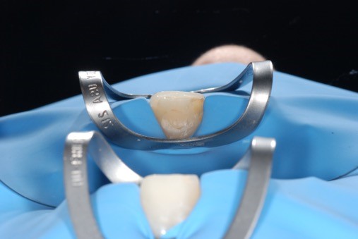 The walking bleach method: Efficient, uncomplicated and minimally ...