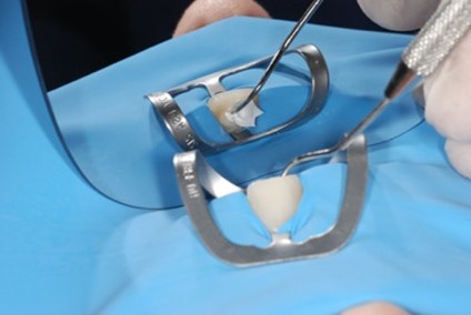 The walking bleach method: Efficient, uncomplicated and minimally ...