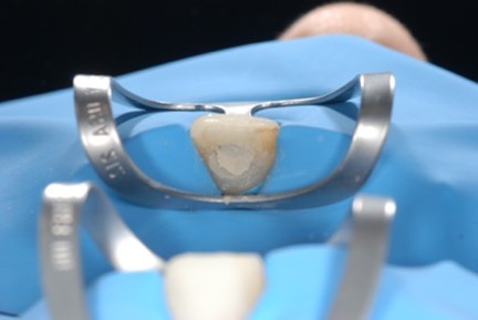 The walking bleach method: Efficient, uncomplicated and minimally ...