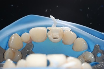 The walking bleach method: Efficient, uncomplicated and minimally ...