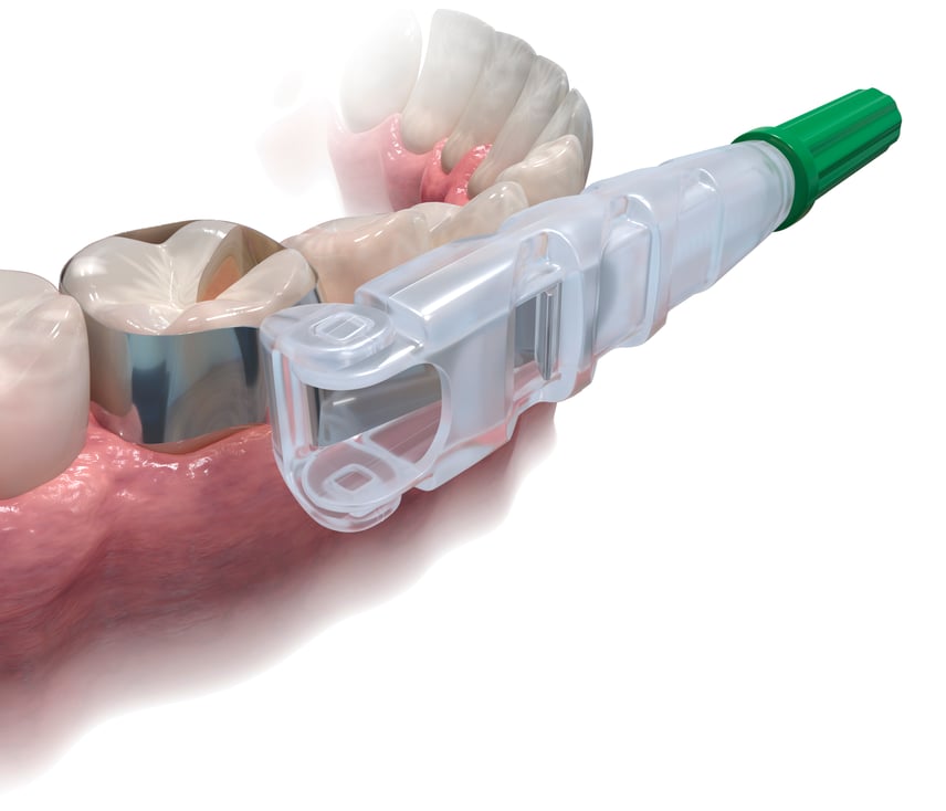 Everything you Loved and More: the new Omni-Matrix Disposable Retainer ...