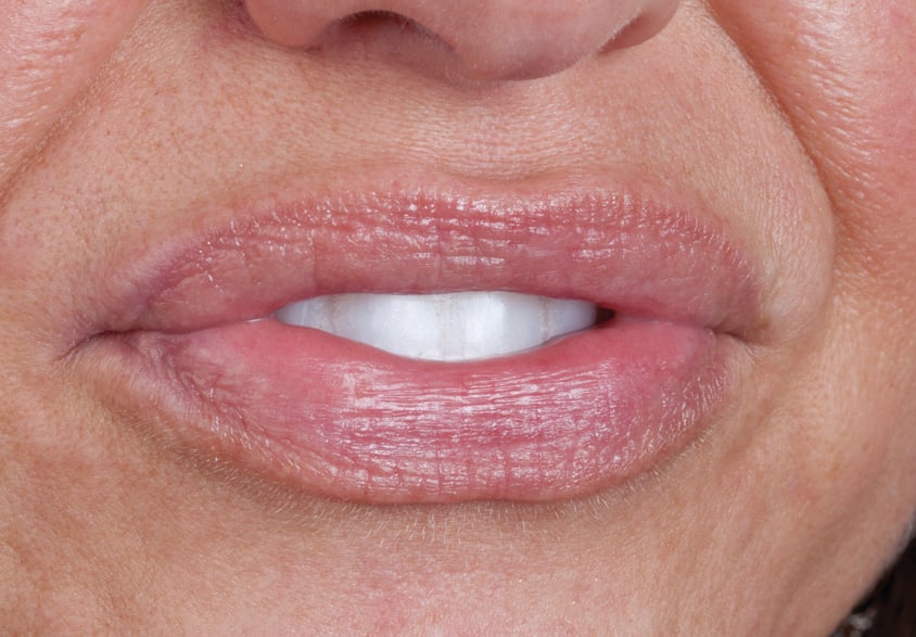 Opalescence Go™ Whitening - quick, simple, convenient!