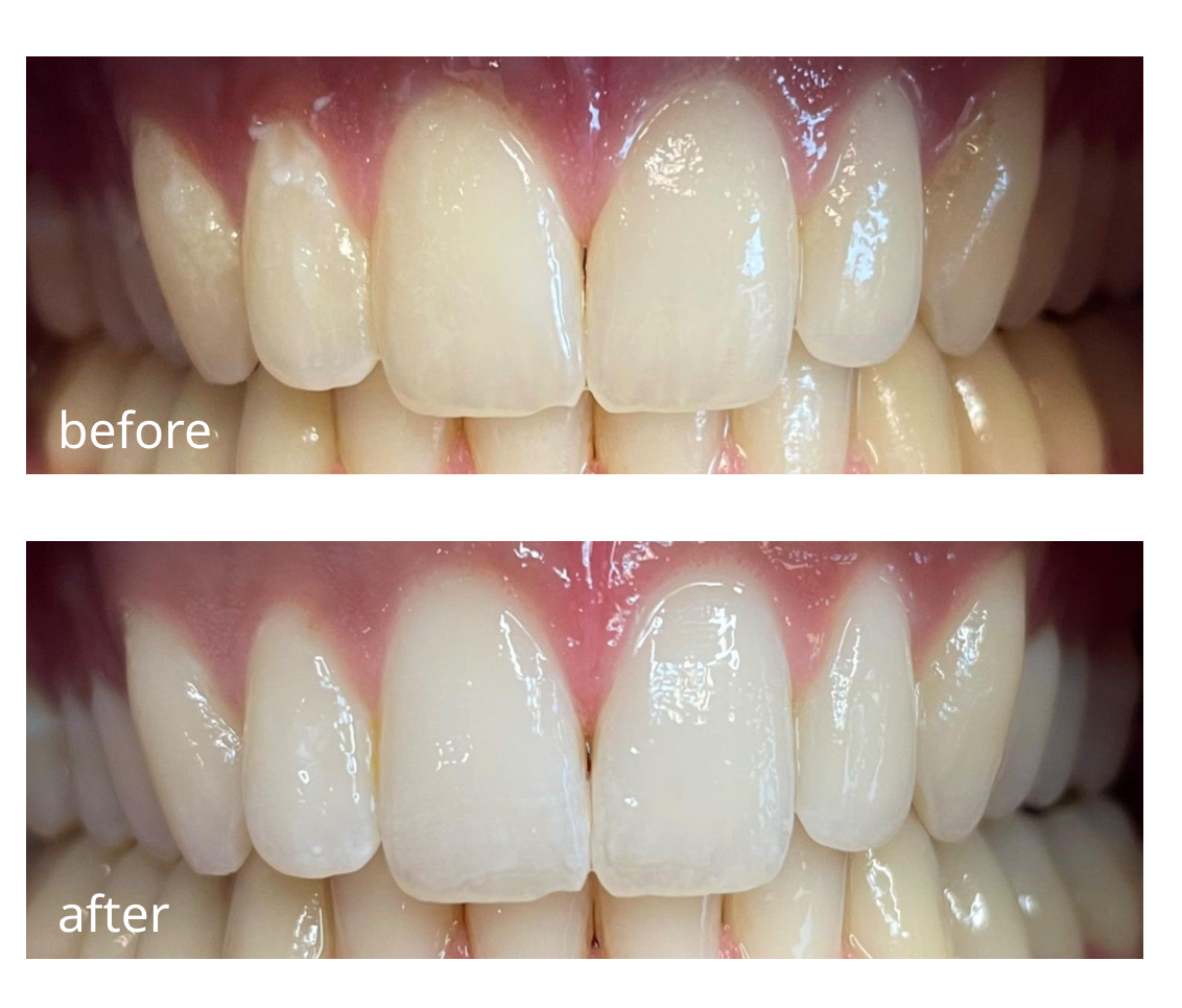 What a difference! Convincing tooth whitening results with Opalescence ...