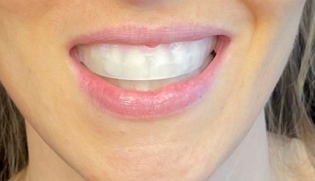 What a difference! Convincing tooth whitening results with Opalescence ...