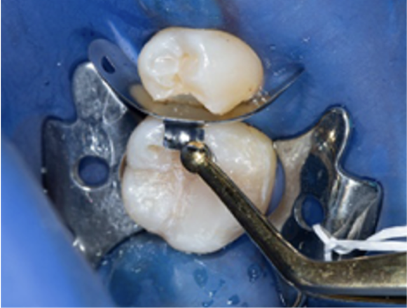 Clinical Guide: Class II Restoration on a Mandibular Second Premolar