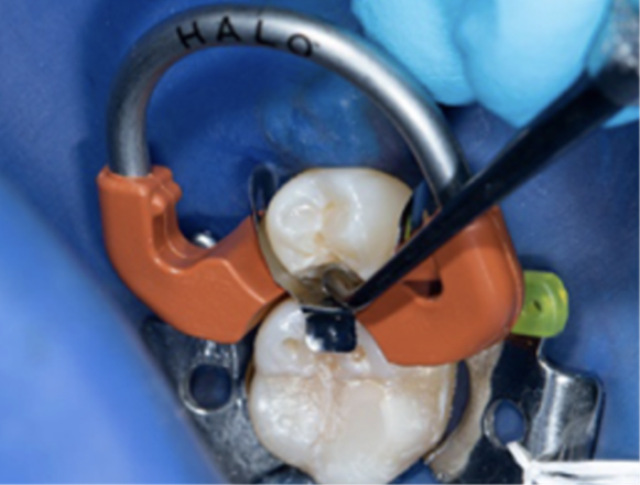 Clinical Guide: Class II Restoration on a Mandibular Second Premolar
