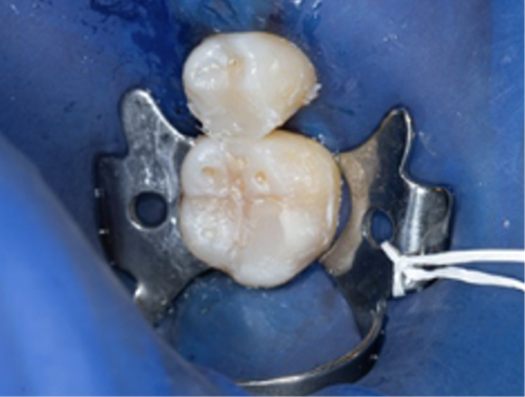 Clinical Guide: Class II Restoration on a Mandibular Second Premolar