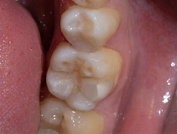 Clinical Guide: Class II Restoration on a Mandibular Second Premolar