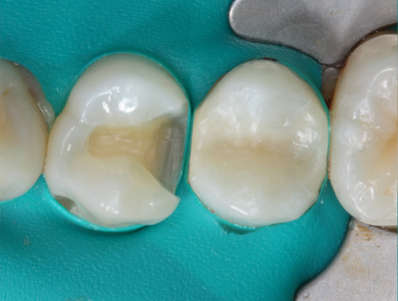 Clinical Guide: Class II Restoration of First Premolar with ...