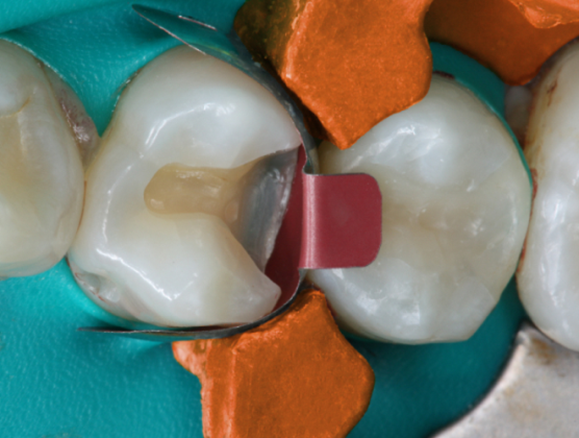Clinical Guide: Class II Restoration of First Premolar with ...
