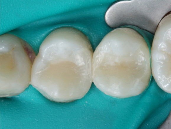 Clinical Guide: Class II Restoration of First Premolar with ...