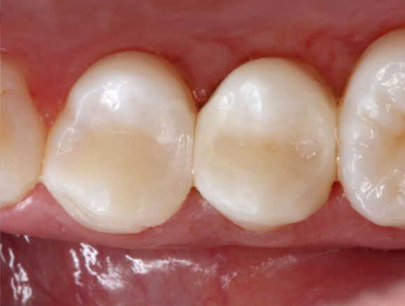 Clinical Guide: Class II Restoration of First Premolar with ...