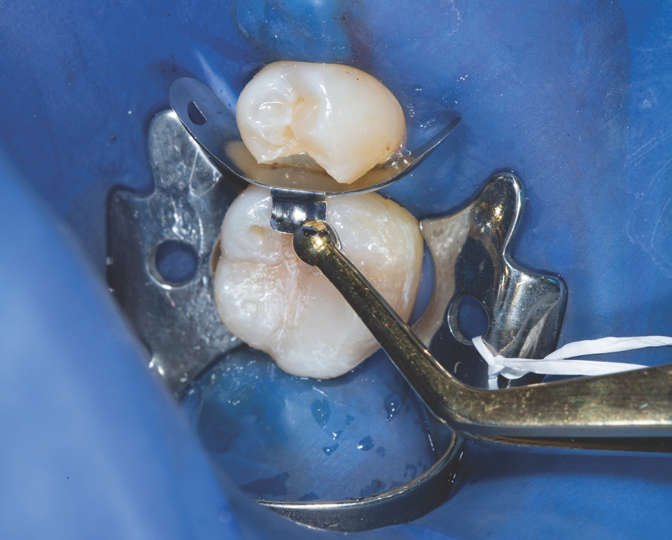 Clinical Guide: Class II Restoration of Tooth #45