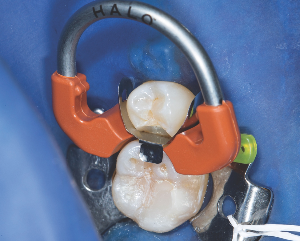 Clinical Guide: Class II Restoration of Tooth #45