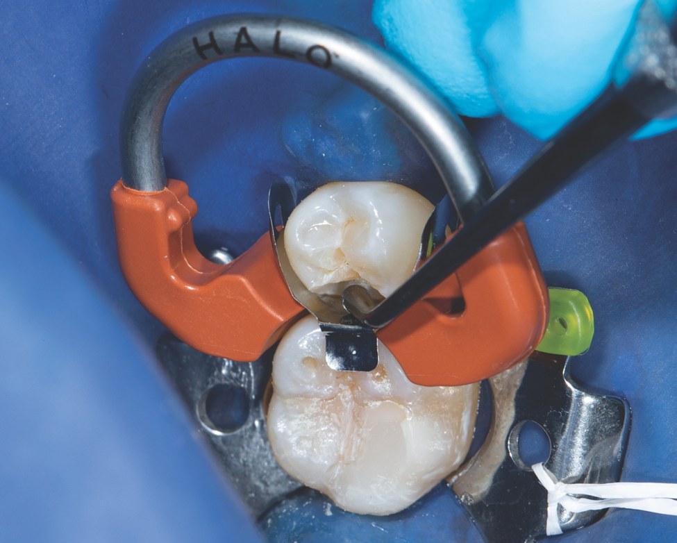 Clinical Guide: Class II Restoration of Tooth #45