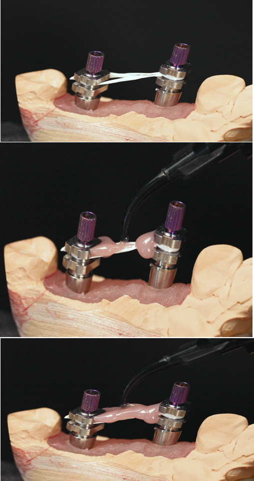 A Multi-Tool for Your Office: J-Temp™ Temporary Resin