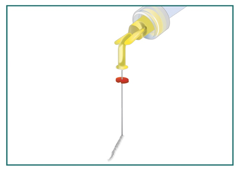 A Simple Guide to Easy Endo Repairs with Endo-Eze™ MTAFlow™ Cement