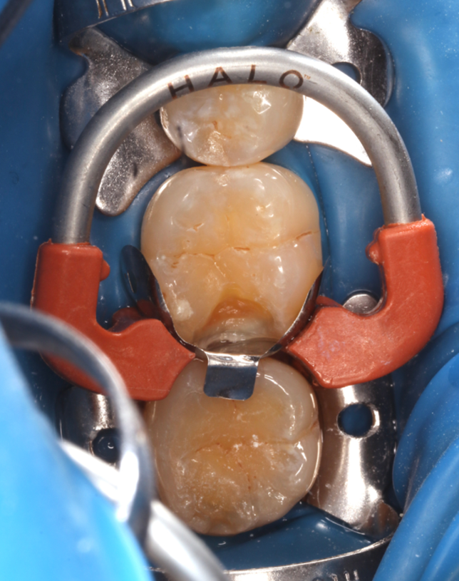 Clinical Guide: Class II Composite Replacement of Chipped Filling